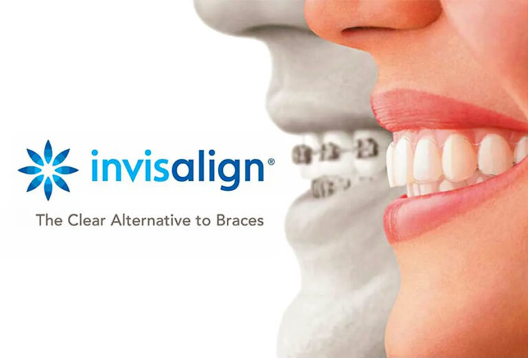 Invisalign Treatment in JP Nagar | Dental Clinic in JP Nagar - Brigade ...